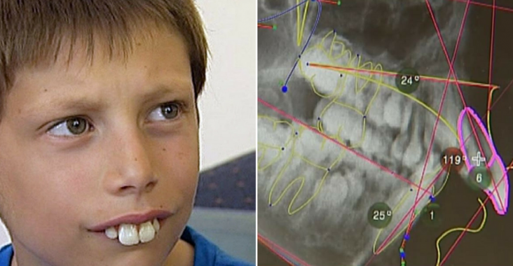 Bucktoothed “Rabbit” Boy Unbelievably Transforms. Find Out How He Looks ...